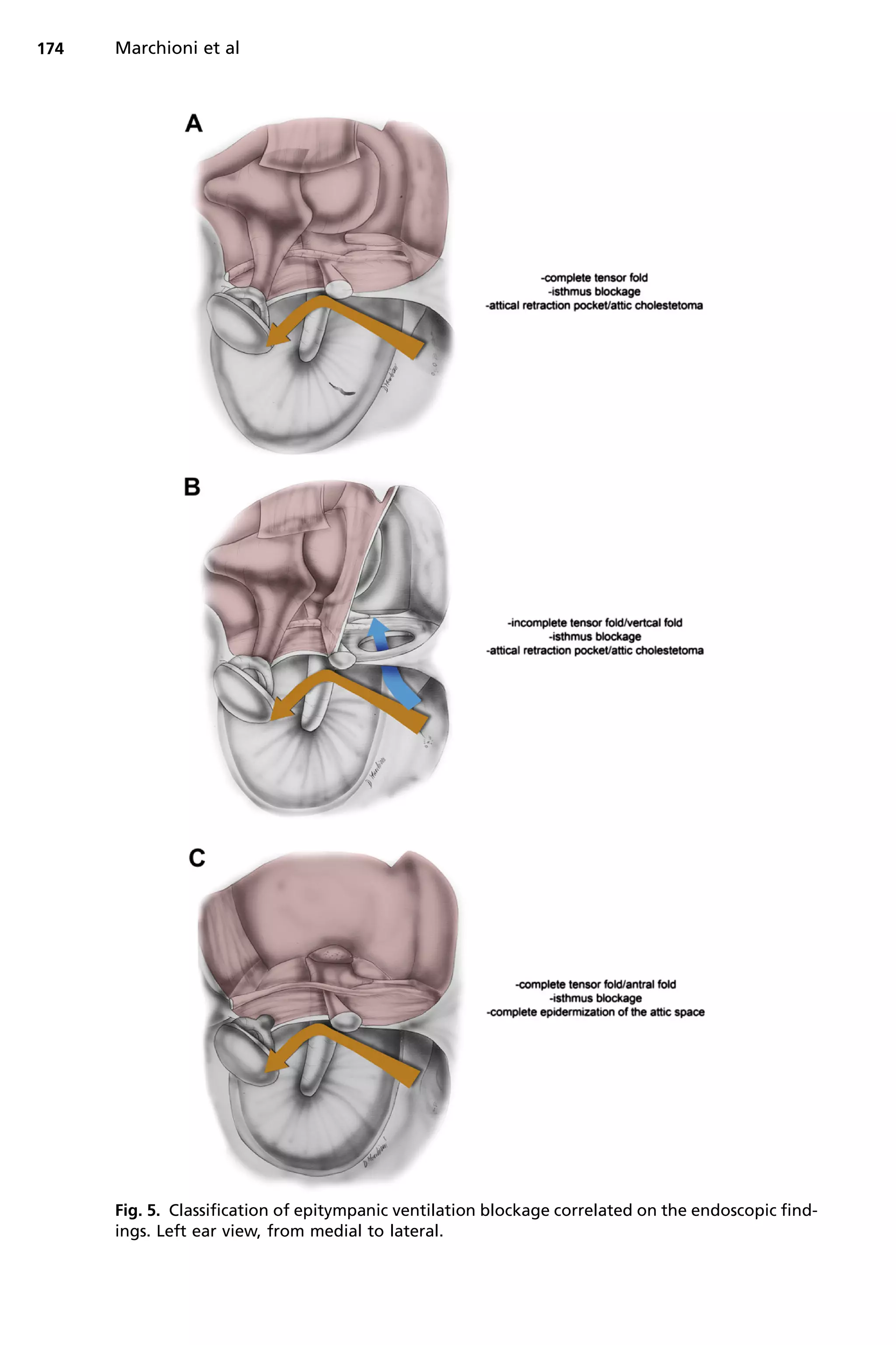 Epitympanic anatomy otolaryngology | PDF