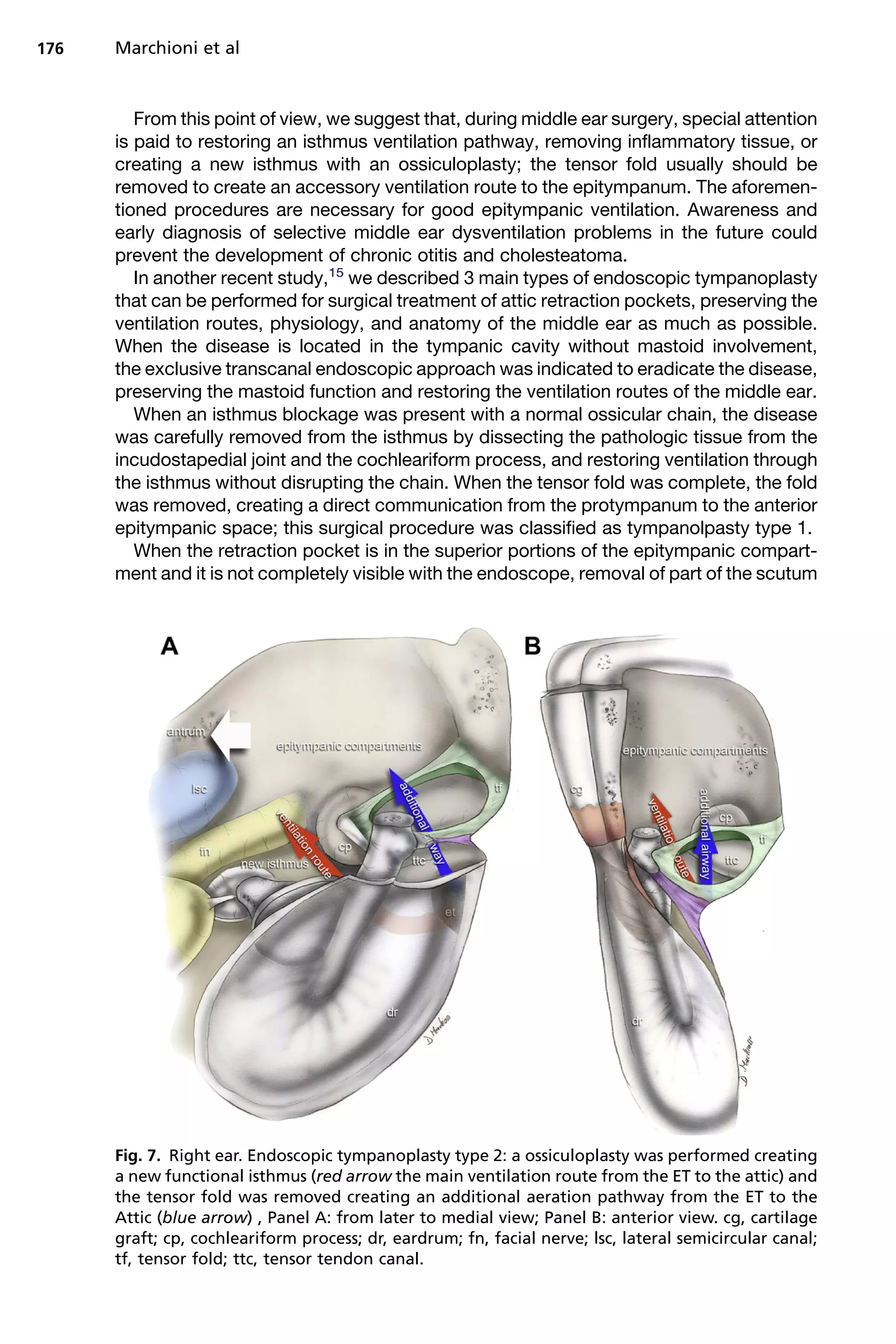 Epitympanic anatomy otolaryngology | PDF