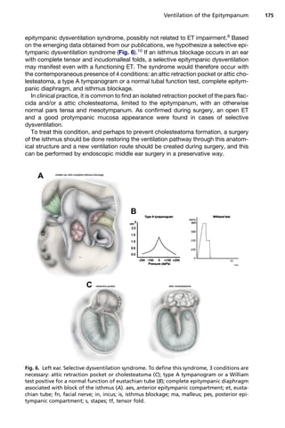 Epitympanic anatomy otolaryngology | PDF