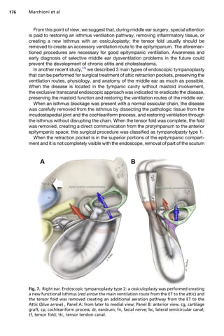 Epitympanic anatomy otolaryngology | PDF