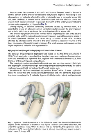 Epitympanic anatomy otolaryngology | PDF