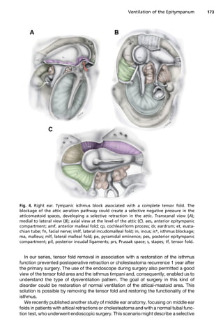 Epitympanic anatomy otolaryngology | PDF