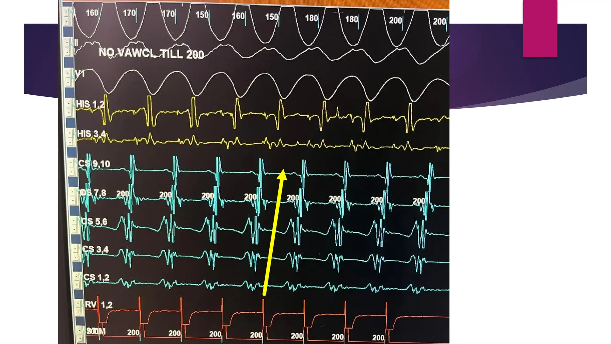 EP MEET EPS SUPRAVENTRICULAR TACHYCARDIA.pptx