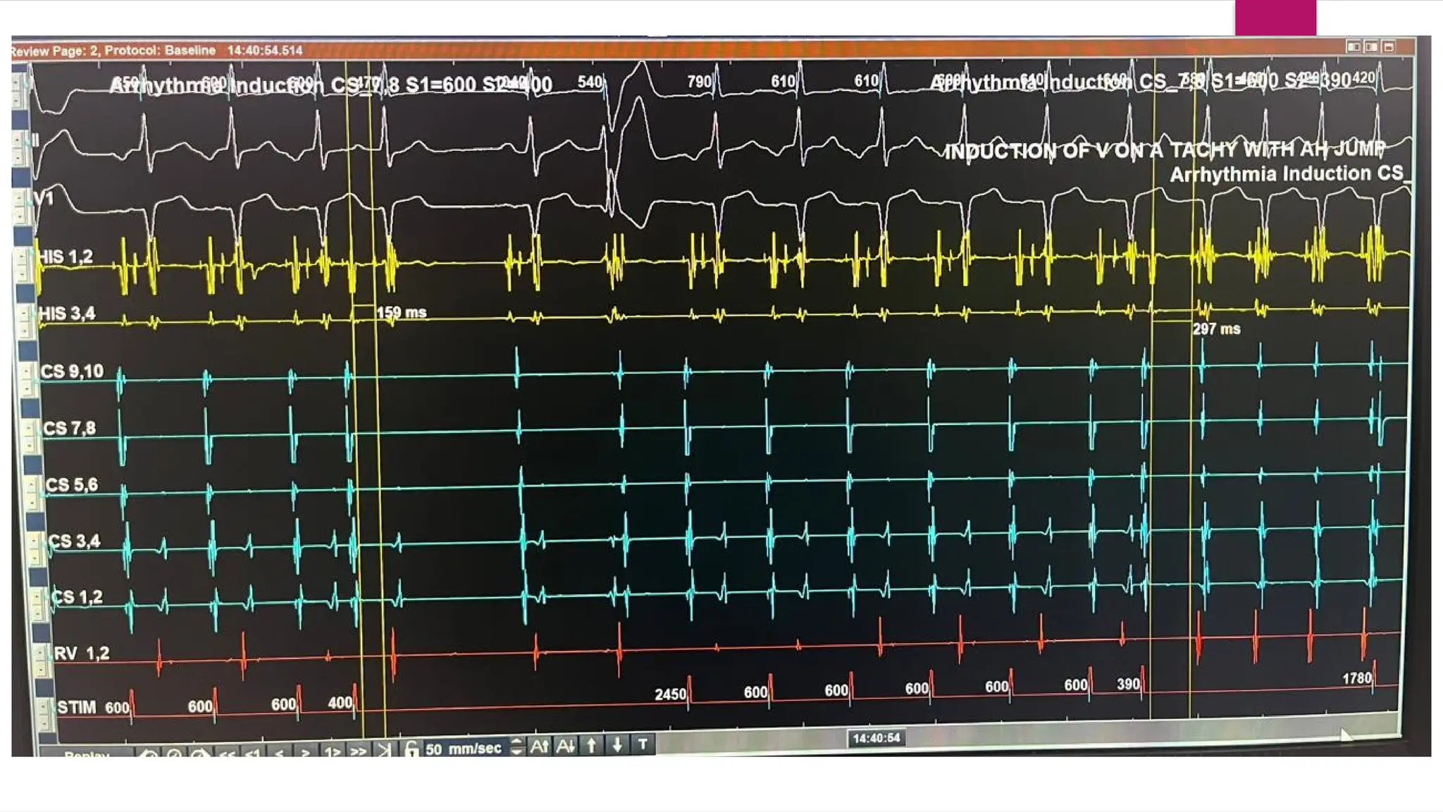 EP MEET EPS SUPRAVENTRICULAR TACHYCARDIA.pptx