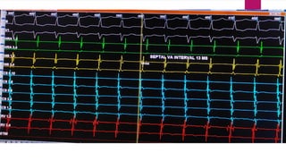 EP MEET EPS SUPRAVENTRICULAR TACHYCARDIA.pptx