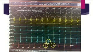 EP MEET EPS SUPRAVENTRICULAR TACHYCARDIA.pptx