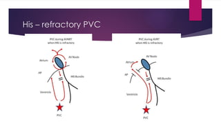 EP MEET EPS SUPRAVENTRICULAR TACHYCARDIA.pptx