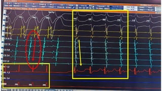 EP MEET EPS SUPRAVENTRICULAR TACHYCARDIA.pptx
