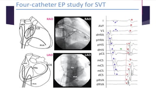 EP MEET EPS SUPRAVENTRICULAR TACHYCARDIA.pptx