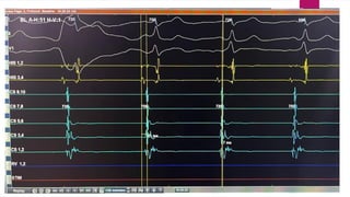 EP MEET EPS SUPRAVENTRICULAR TACHYCARDIA.pptx