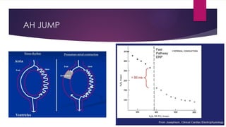 EP MEET EPS SUPRAVENTRICULAR TACHYCARDIA.pptx