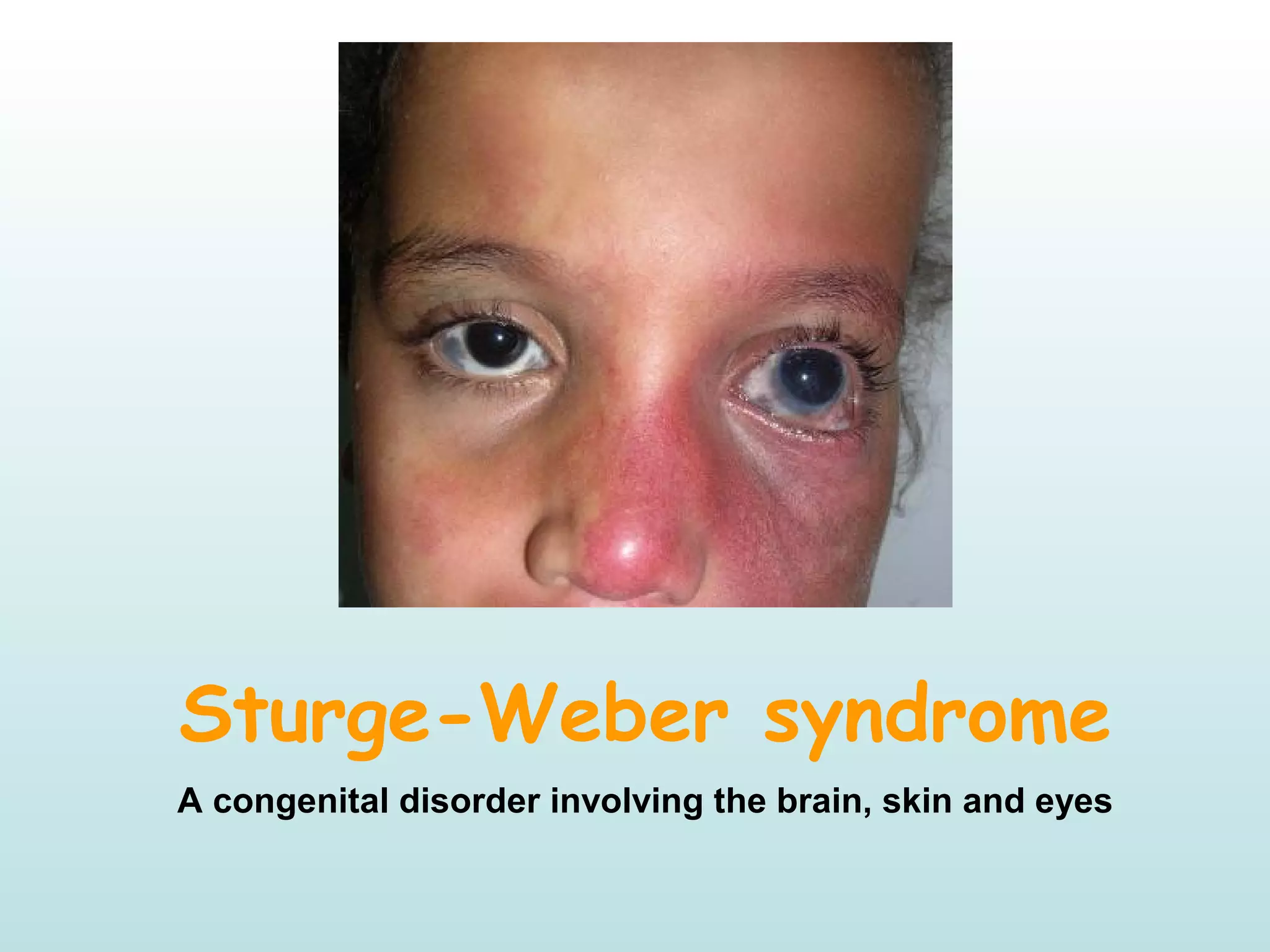 Ophthalmology Eponyms ! | PPT | Eye and Vision Conditions | Diseases ...