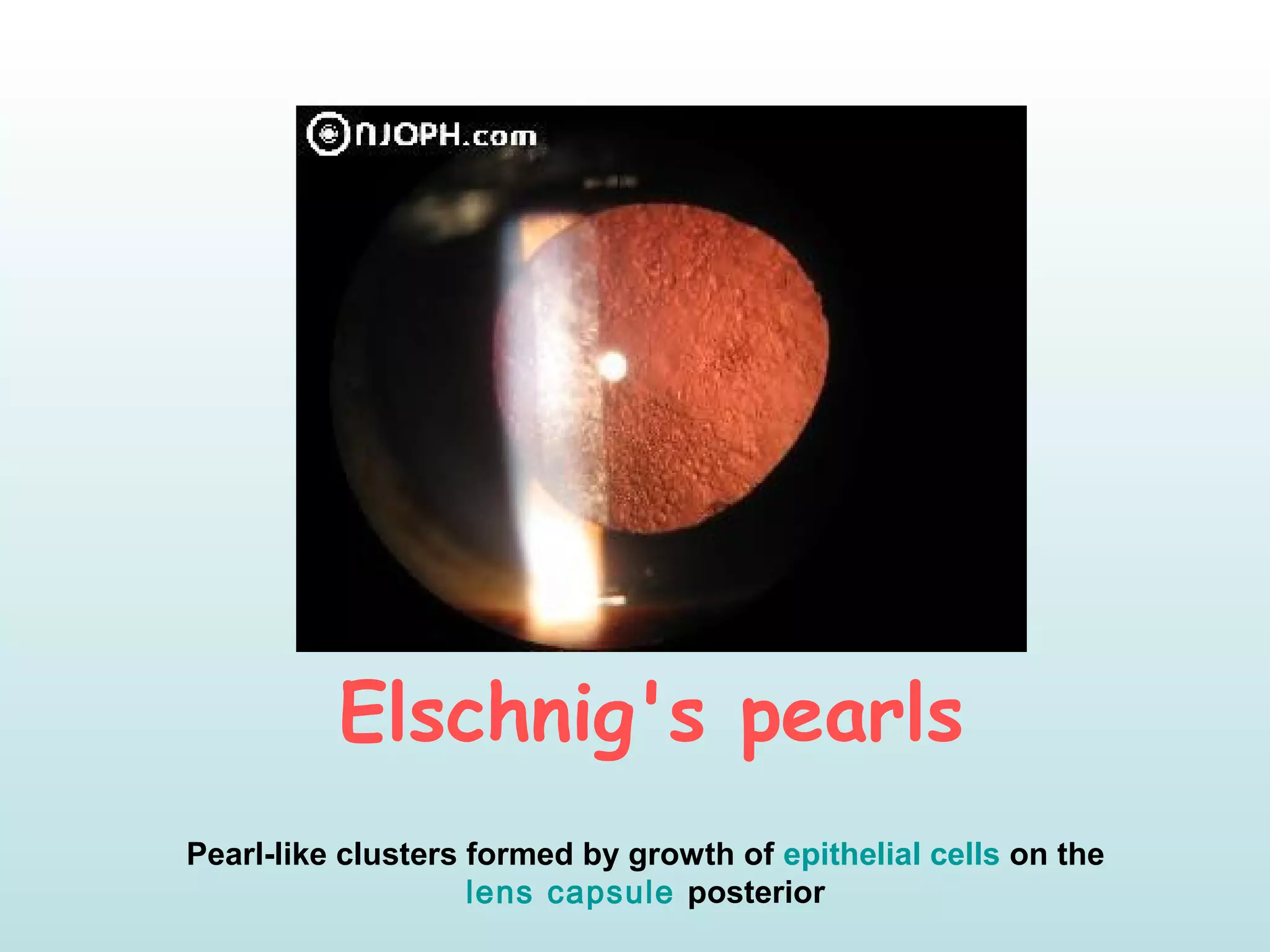 Ophthalmology Eponyms ! | PPT | Eye and Vision Conditions | Diseases ...