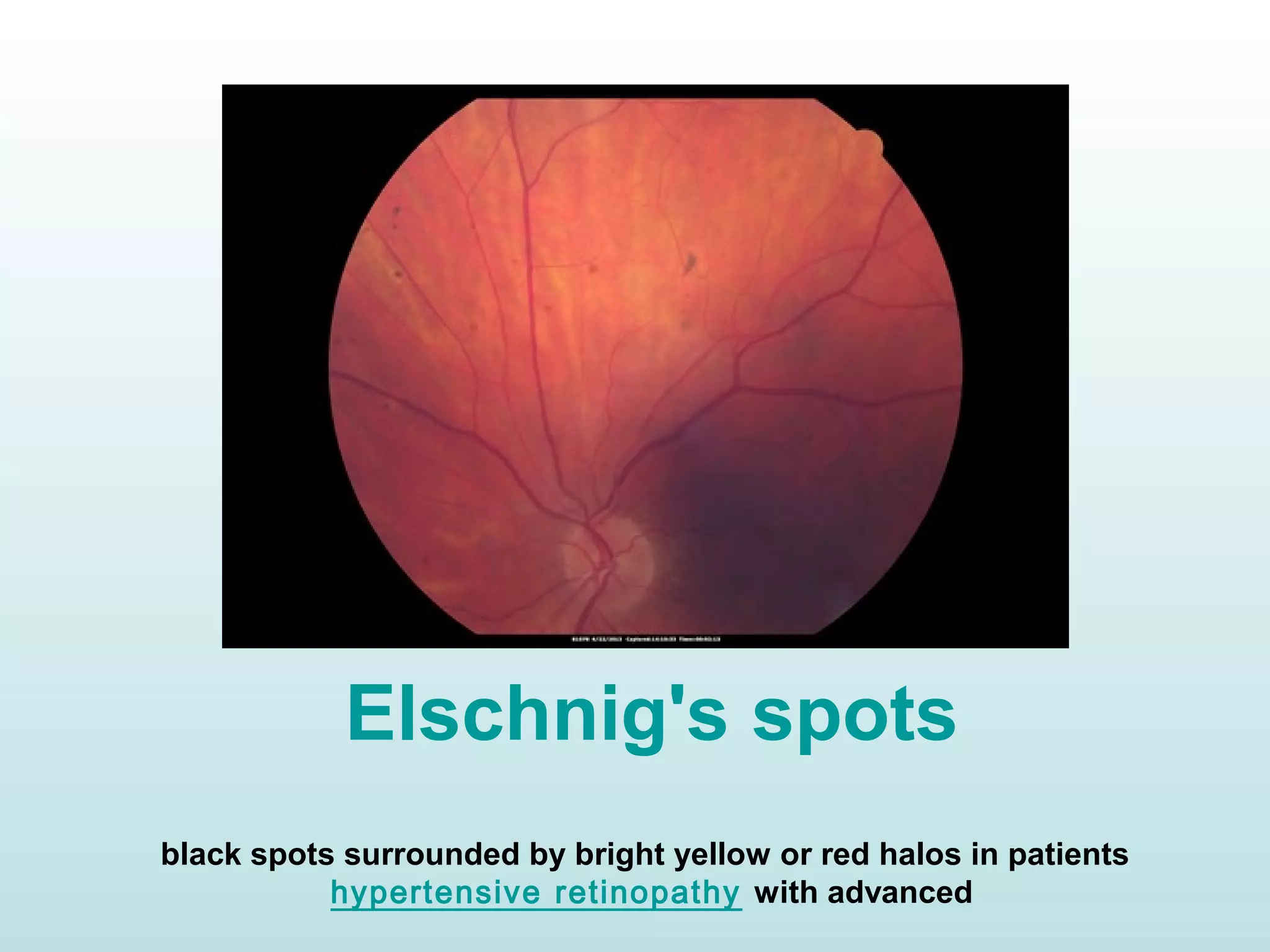 Ophthalmology Eponyms ! | PPT