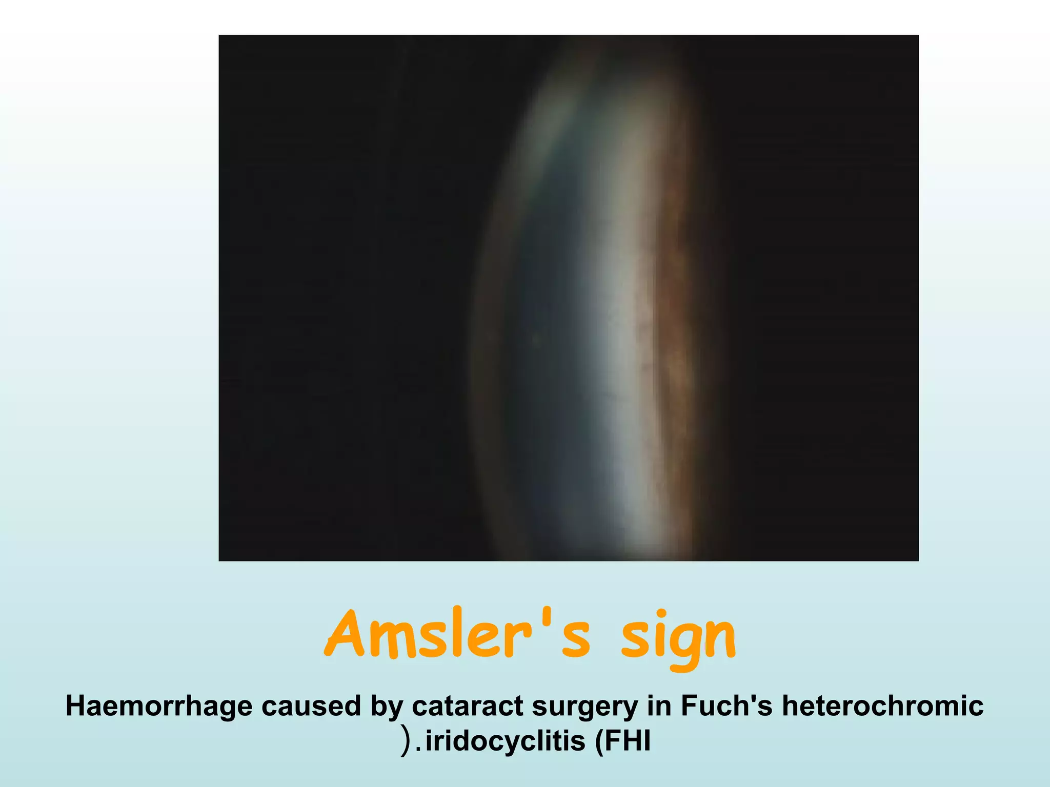 Ophthalmology Eponyms ! | PPT