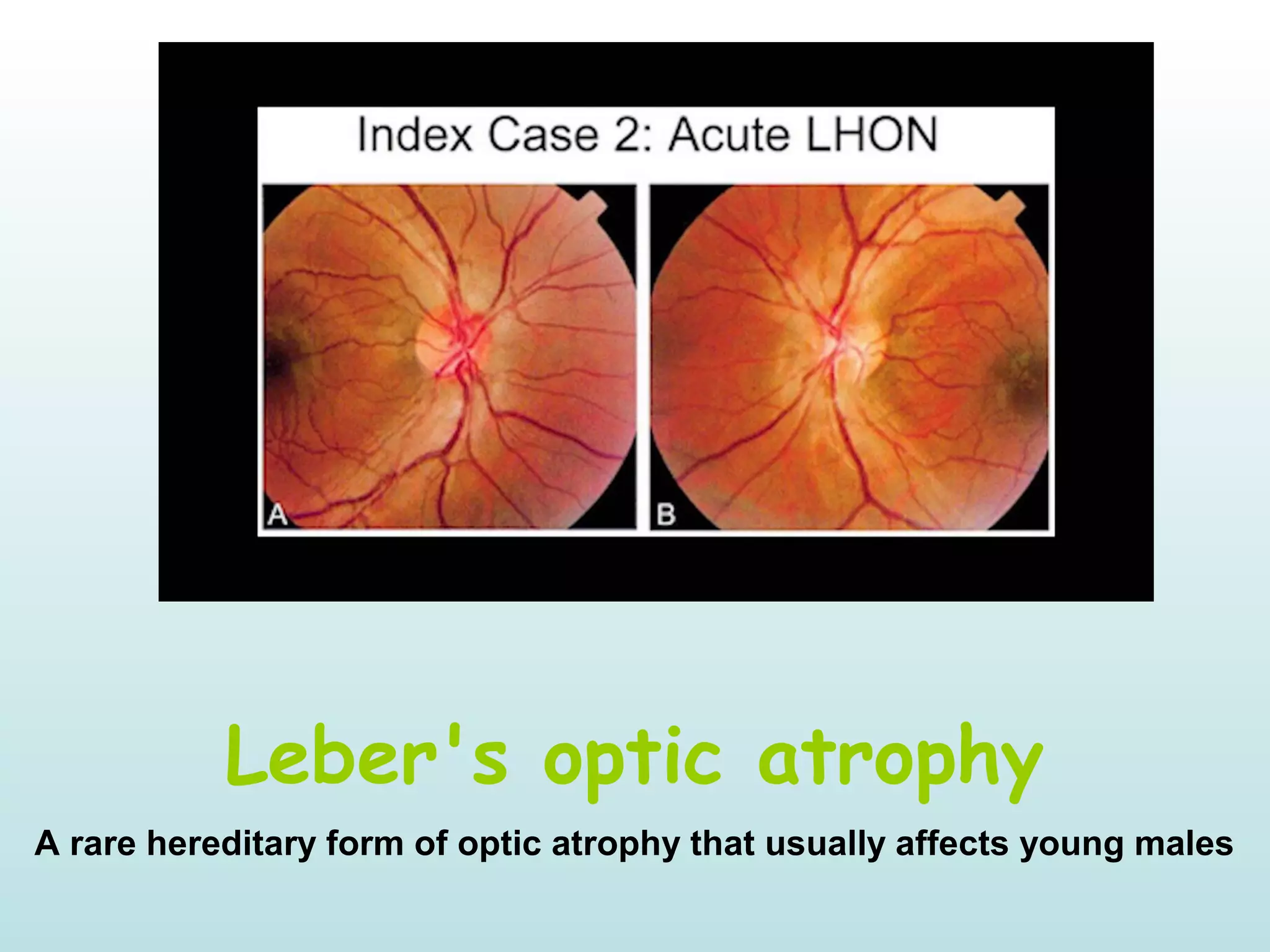 Ophthalmology Eponyms ! | PPT | Eye and Vision Conditions | Diseases ...