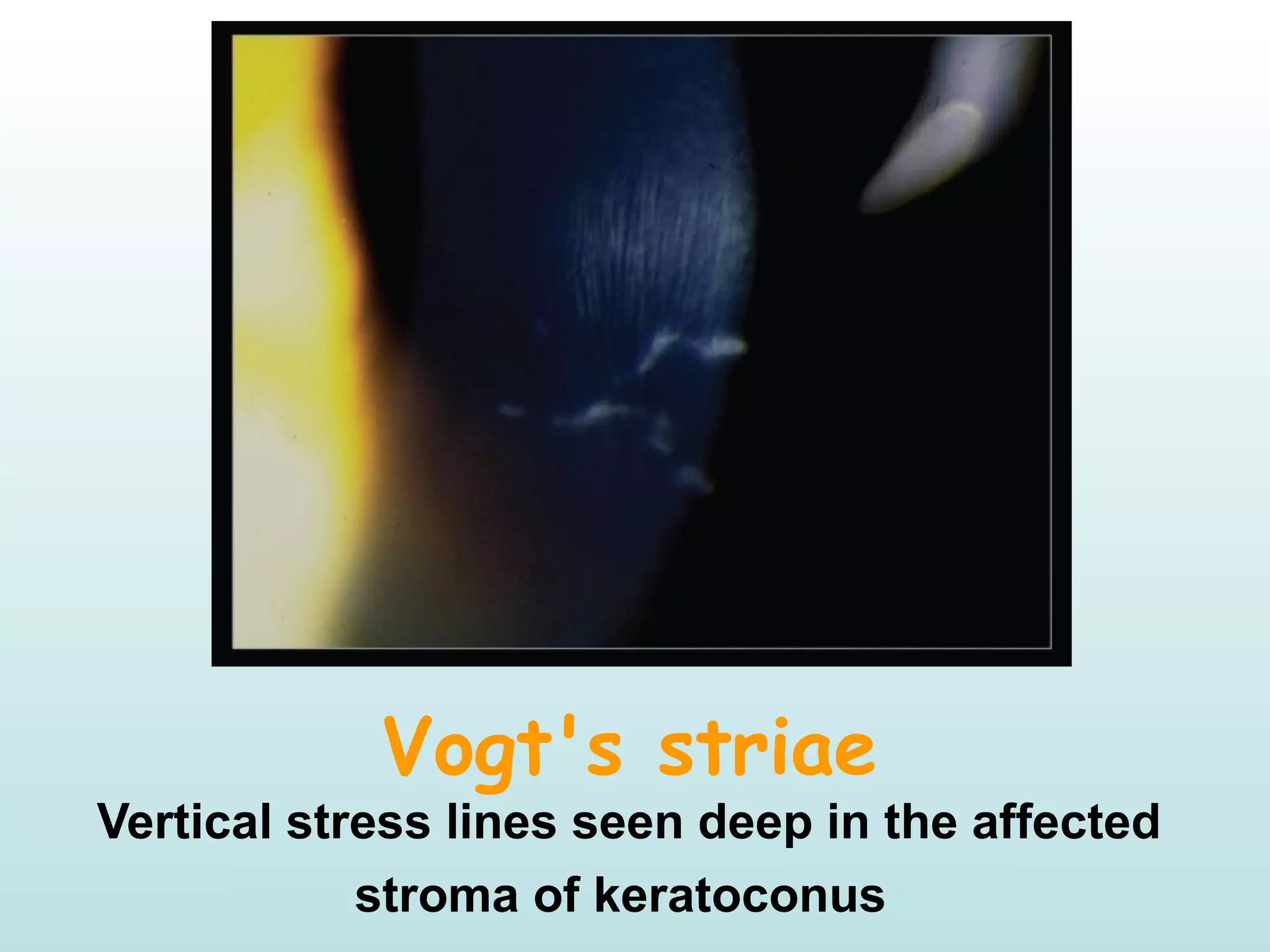 Ophthalmology Eponyms ! | PPT | Eye and Vision Conditions | Diseases ...