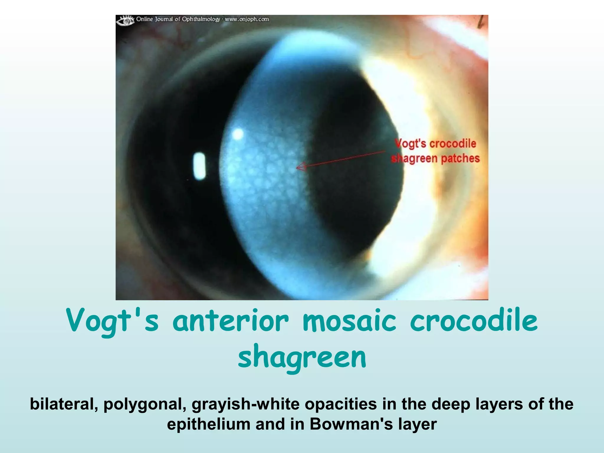 Ophthalmology Eponyms ! | PPT | Eye and Vision Conditions | Diseases ...