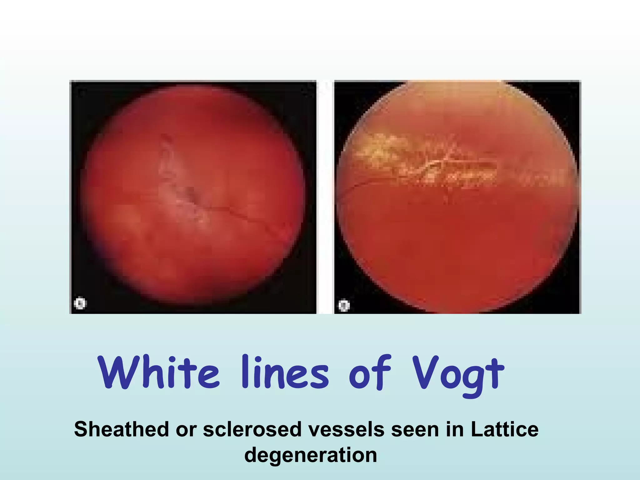 Ophthalmology Eponyms ! | PPT | Eye and Vision Conditions | Diseases ...