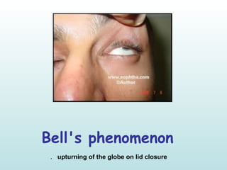 Ophthalmology Eponyms ! | PPT