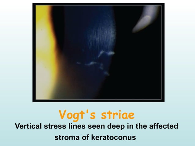 Ophthalmology Eponyms ! | PPT | Eye and Vision Conditions | Diseases ...