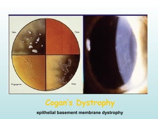 Ophthalmology Eponyms ! | PPT