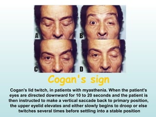 Ophthalmology Eponyms ! | PPT