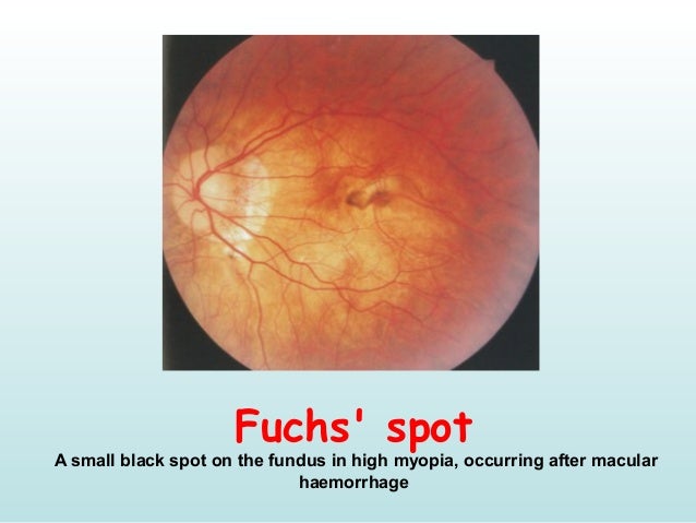 Ophthalmology Eponyms