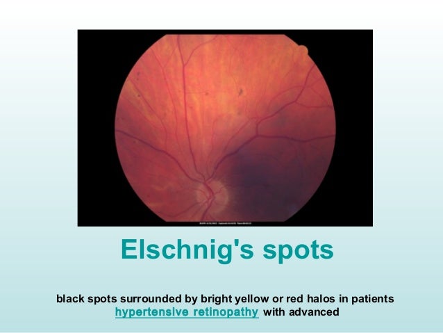 Ophthalmology Eponyms