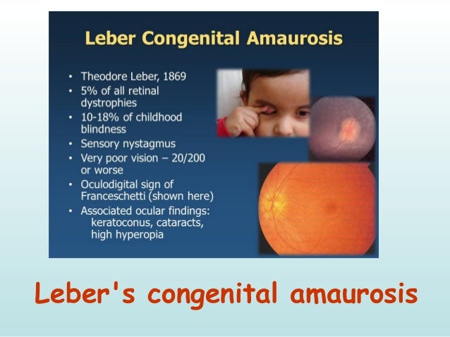 Ophthalmology Eponyms