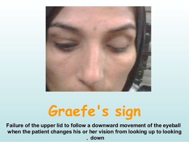 Ophthalmology Eponyms