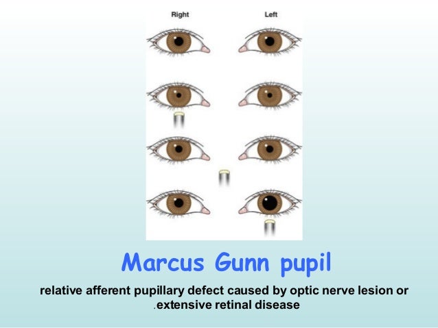 Ophthalmology Eponyms