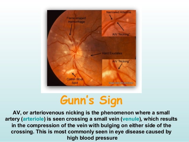 Ophthalmology Eponyms