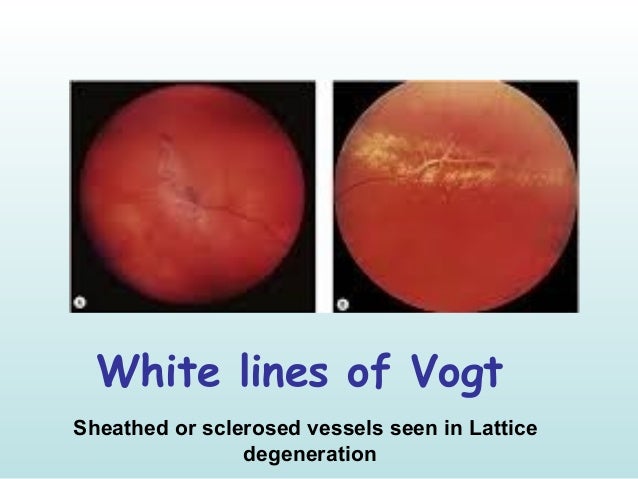 Ophthalmology Eponyms