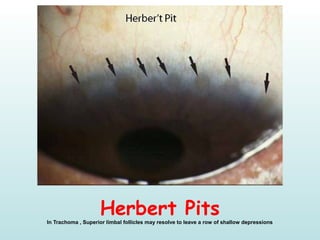 Herbert Pits