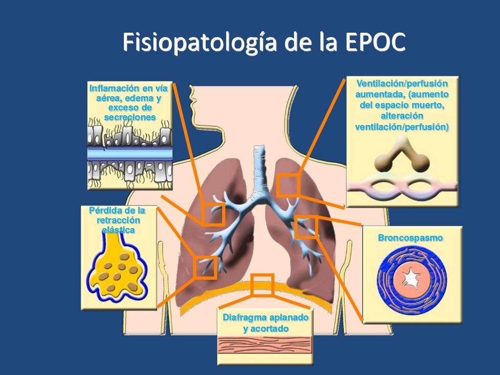 Enfermedad pulmonar obstructiva cronica