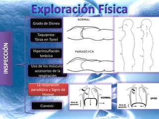 Enfermedad Pulmonar Obstructiva Crónica- Caso Clínico | PPTX