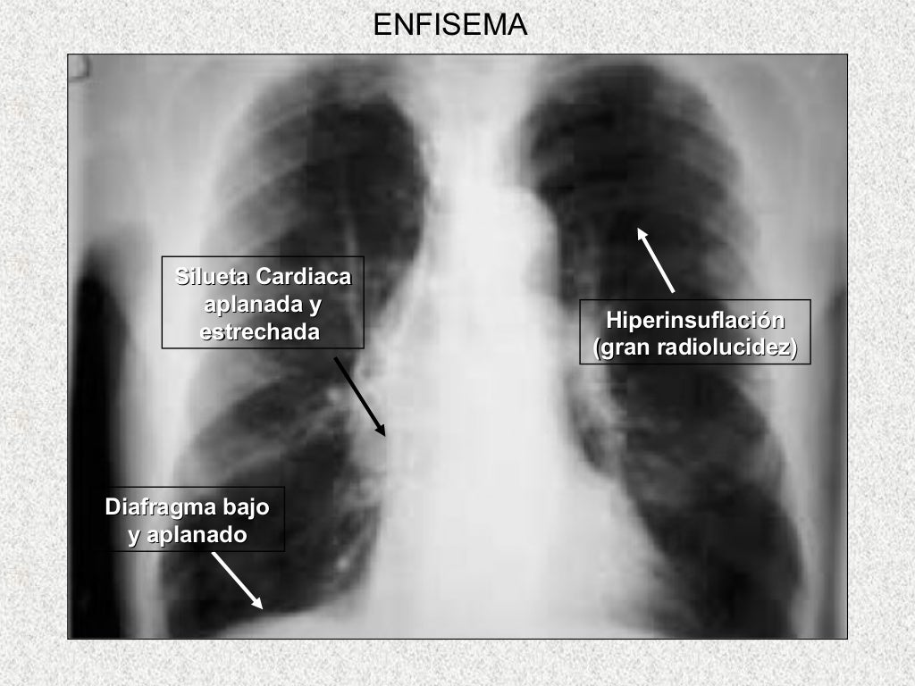Epoc semiología