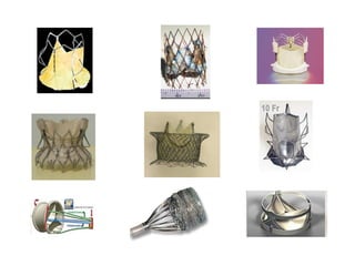 TAVI: transcatheter valve implant | PPT | Surgery | Medical Health