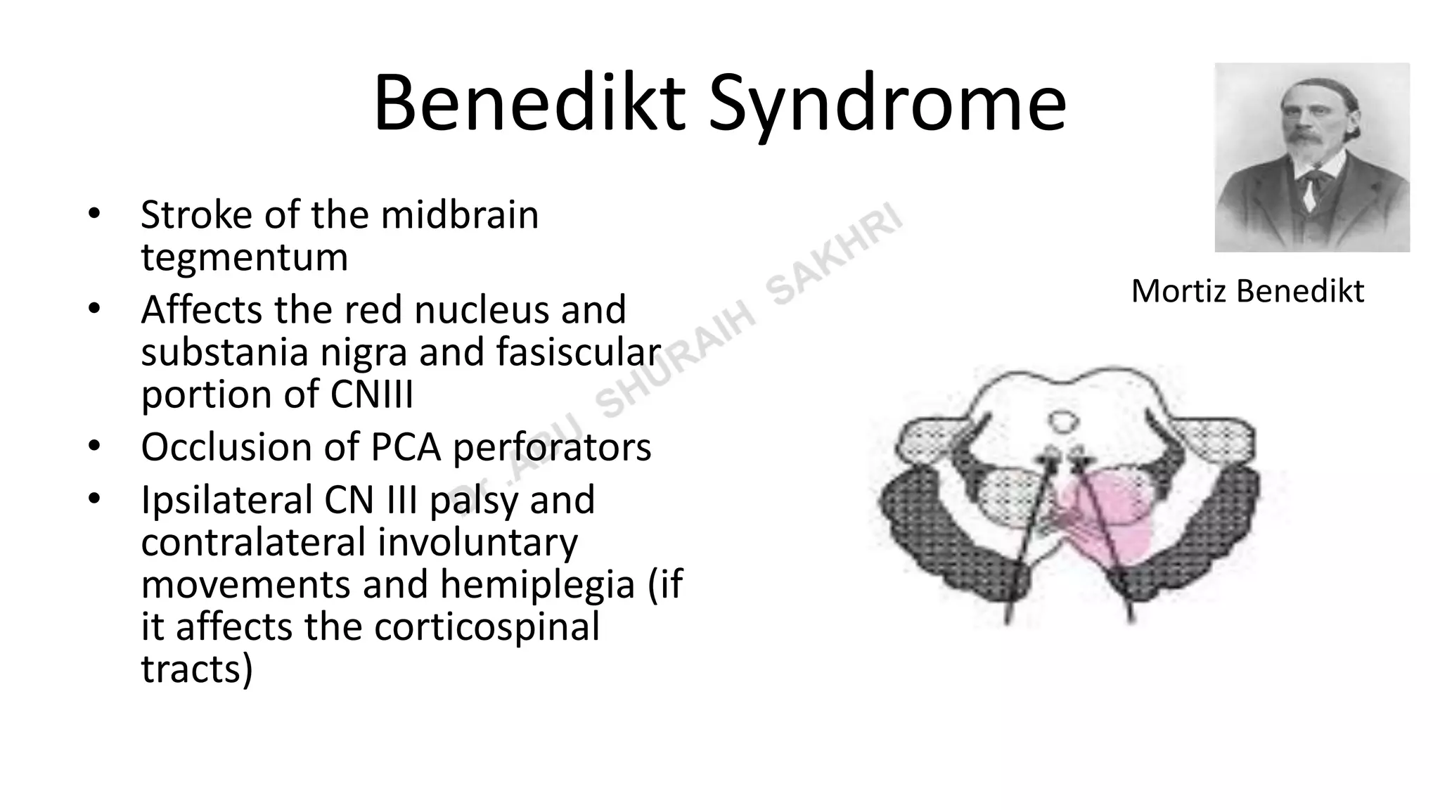 Eponymous brainstem stroke syndromes | PPTX