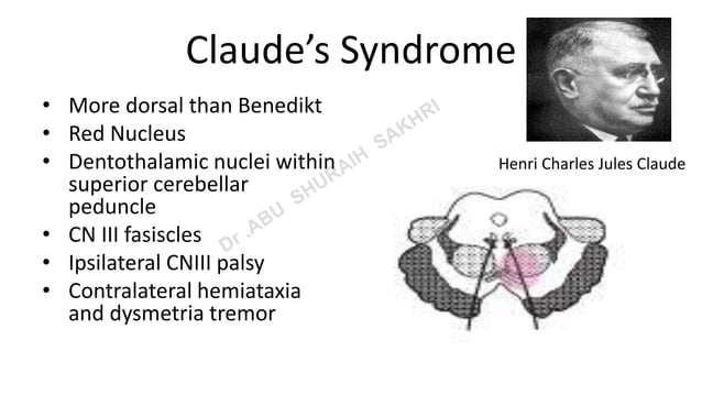 Eponymous brainstem stroke syndromes | PPTX