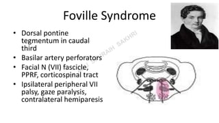Eponymous brainstem stroke syndromes | PPTX