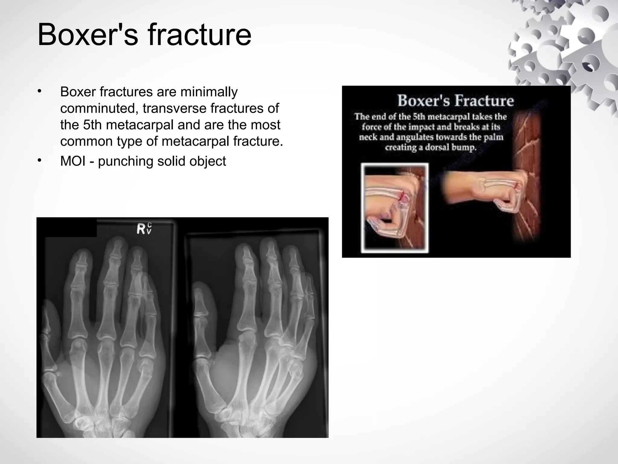 eponymousfractures-160228213145.pdf