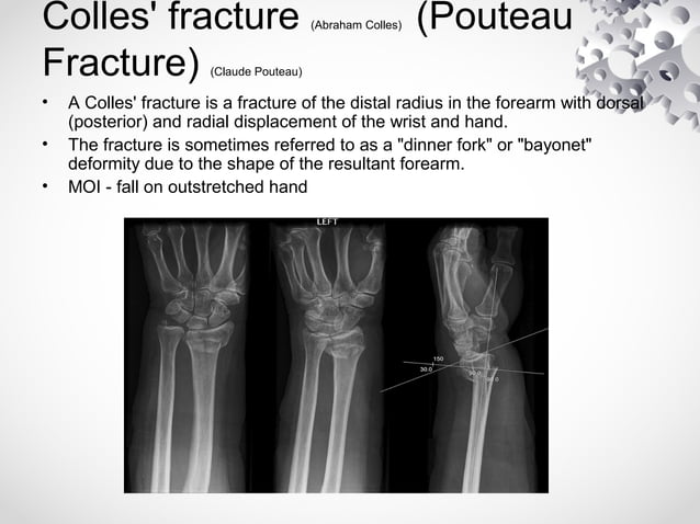 eponymousfractures-160228213145.pdf