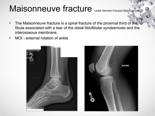 eponymousfractures-160228213145.pdf
