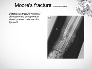 eponymousfractures-160228213145.pdf