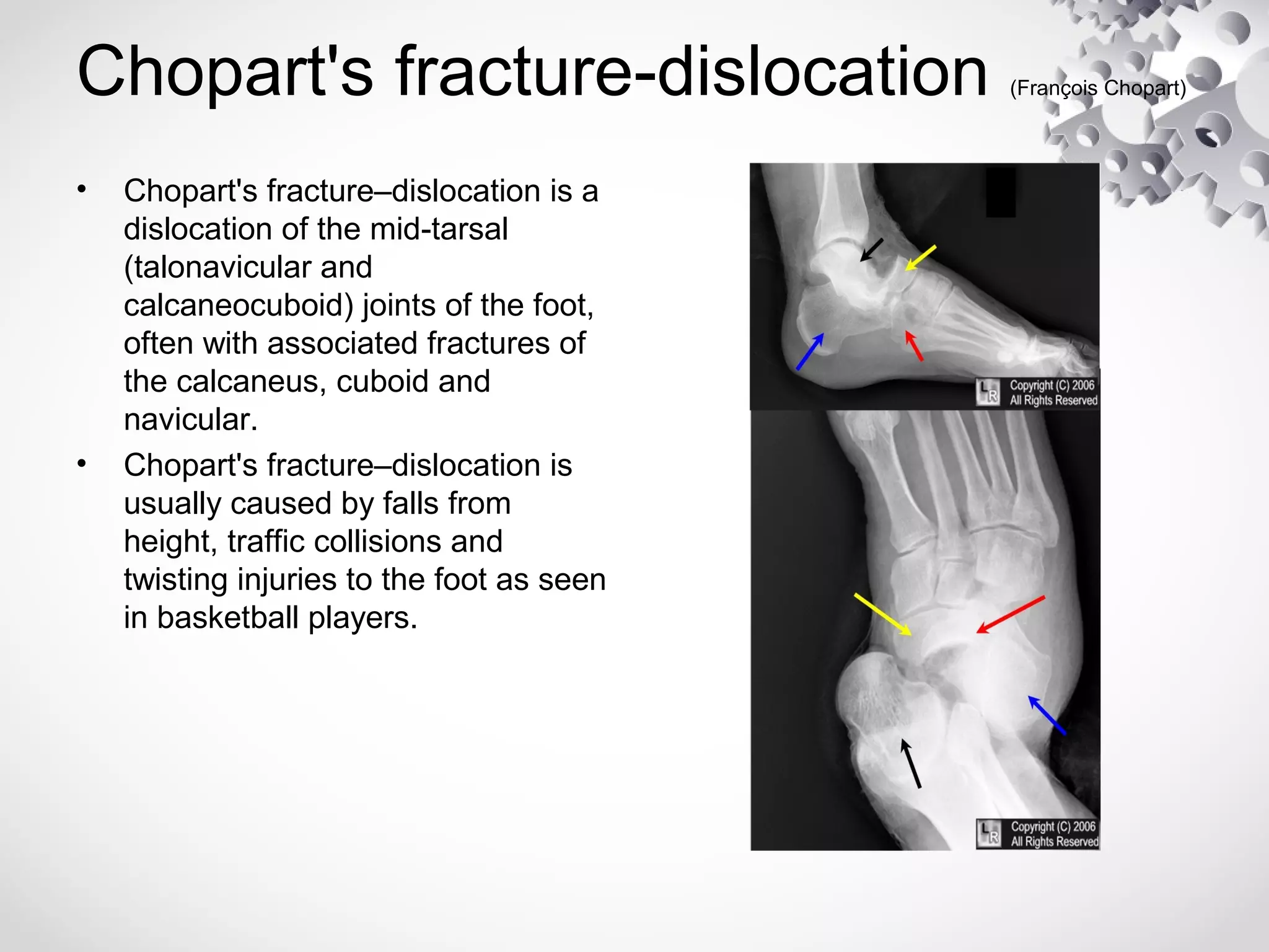 Eponymous fractures | PPT