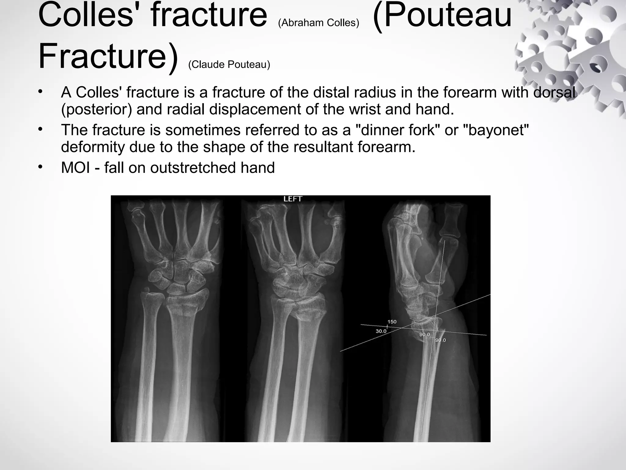 Eponymous fractures | PPT