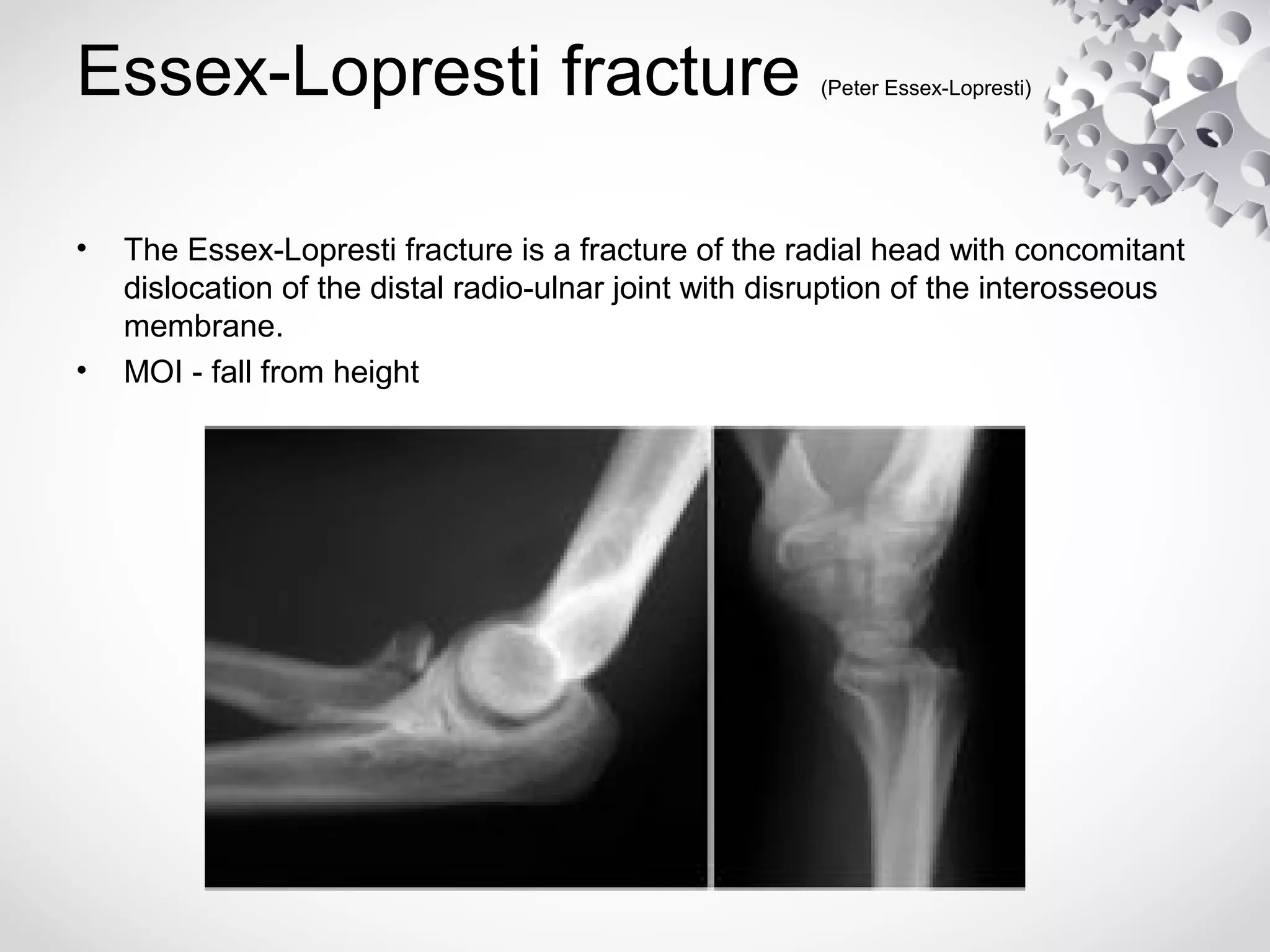 Eponymous fractures | PPT