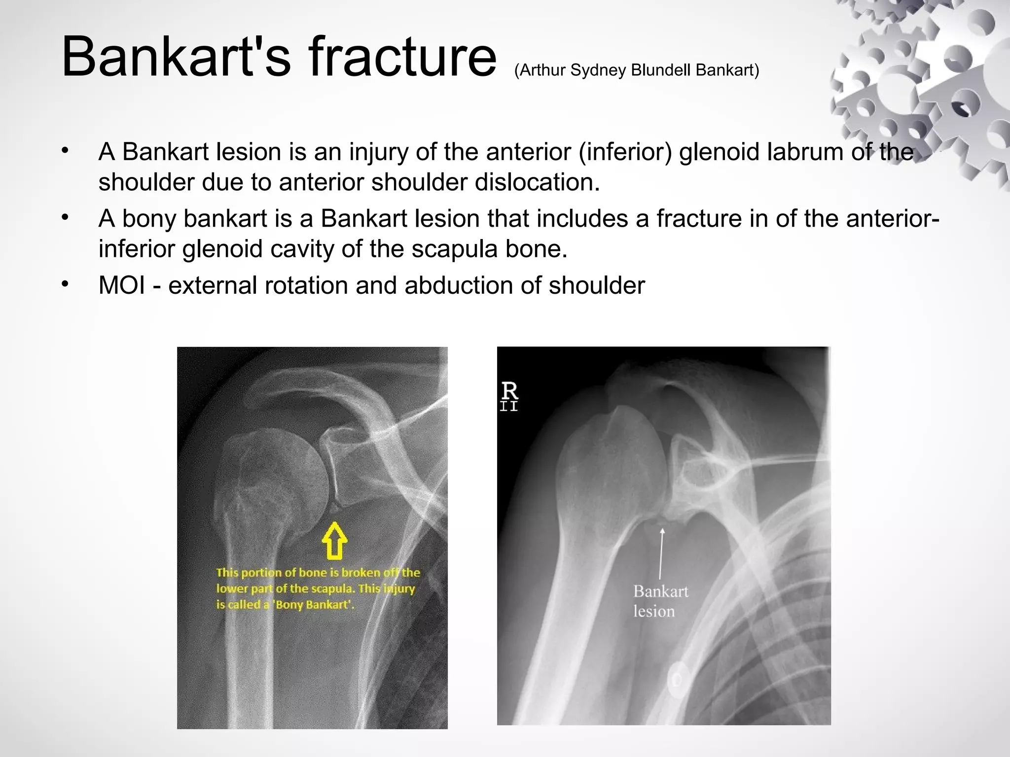 Eponymous fractures | PPT
